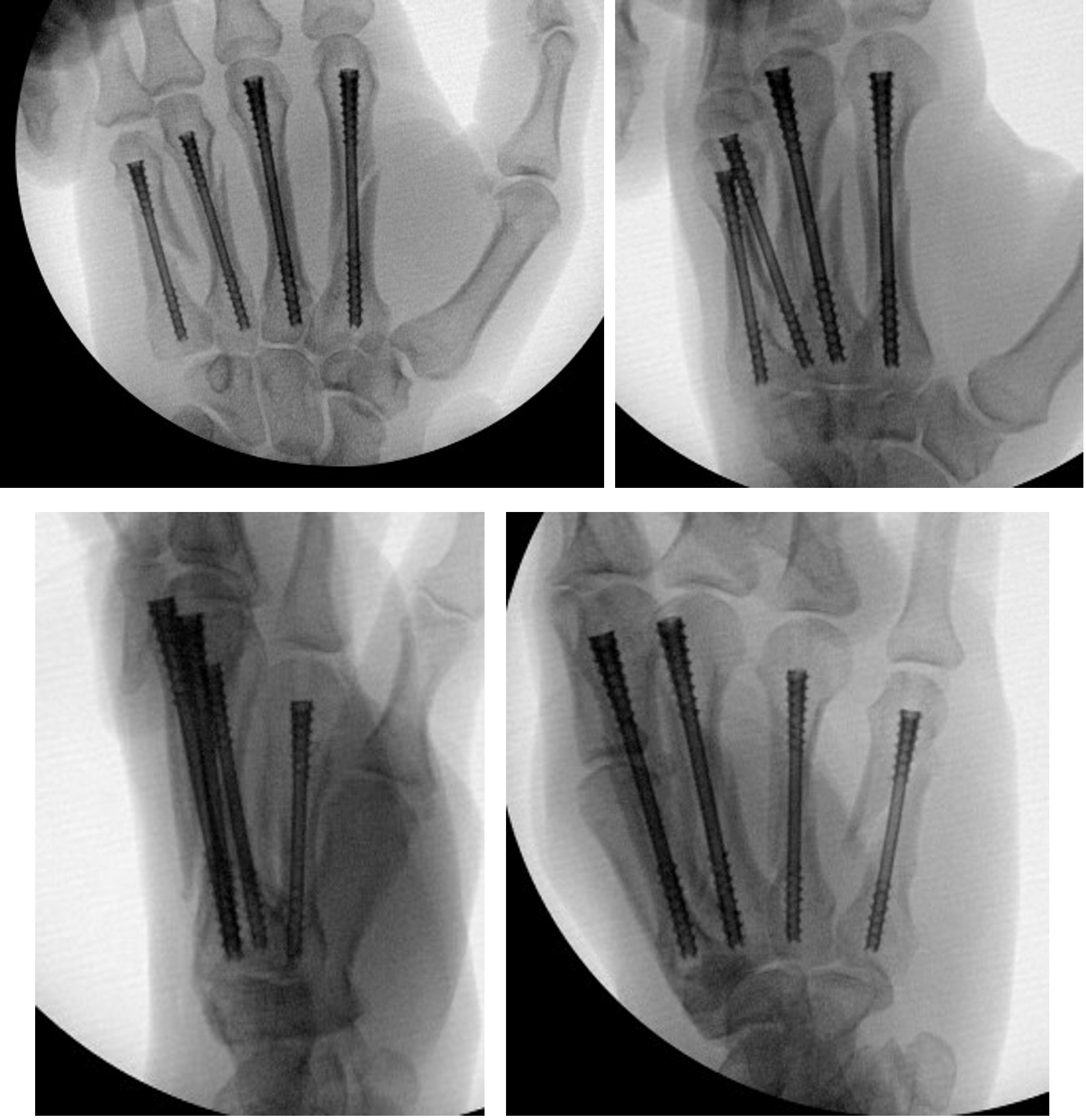 Case Reports: NX Nail and Microscrew | Hand Fracture Management